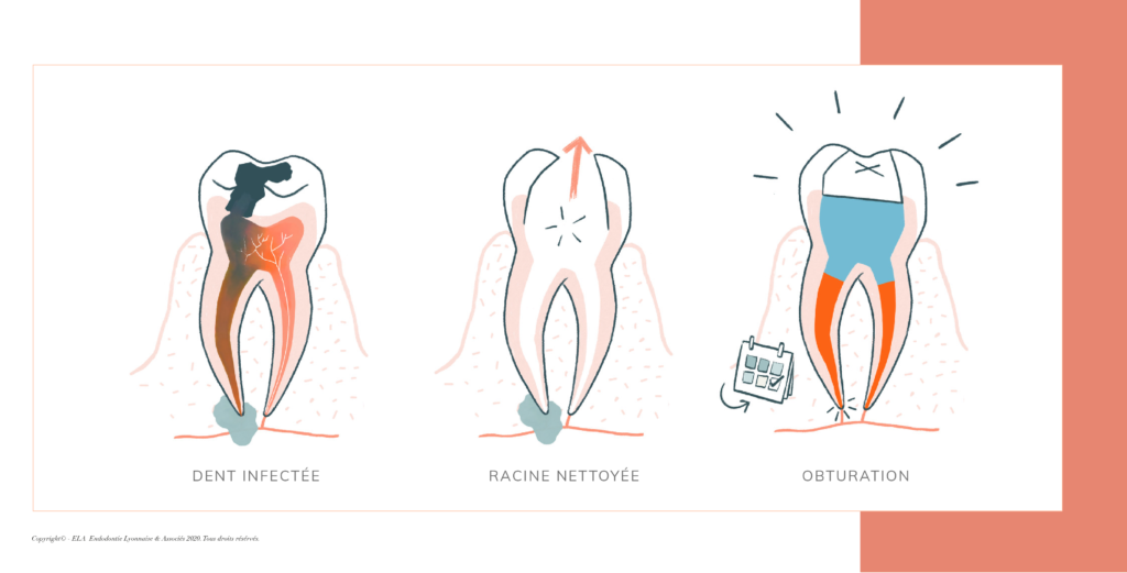 Endodontie - Endoela